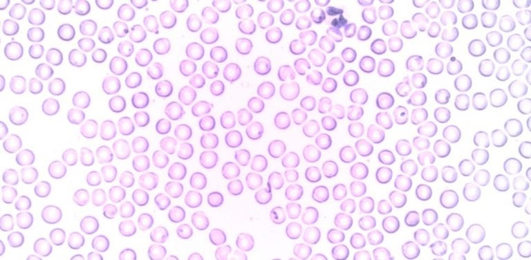 Limfocite crescute – ce înseamnă și care sunt cauzele - Cancer360