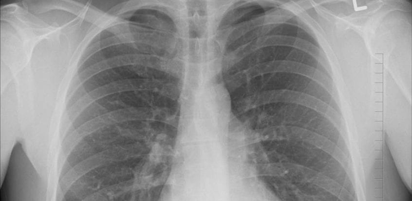 Toracoscopia – ce este si cand se recomanda - Cancer360