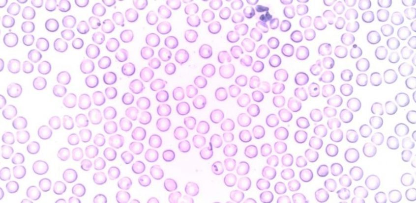 Leucocite scazute - ce inseamna si care sunt cauzele - Cancer360