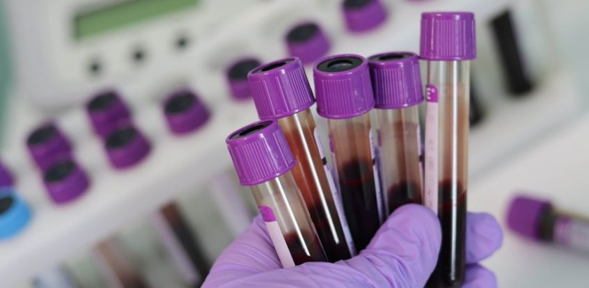 Calcitonina - ce trebuie sa stii despre acest hormon tiroidian - Cancer360