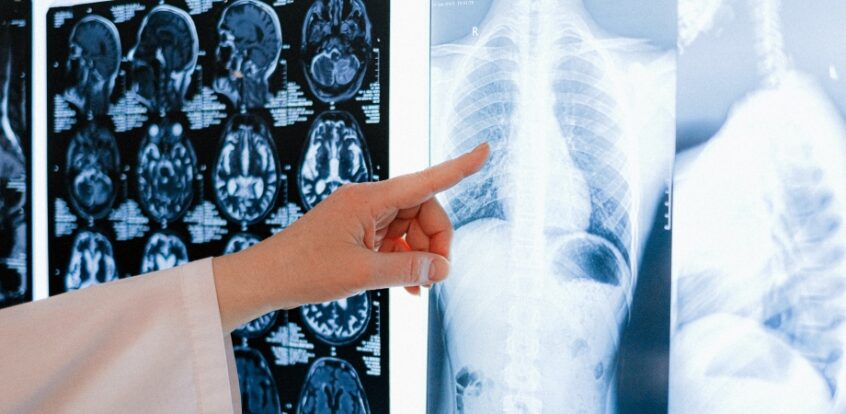 Metastaze pulmonare – cauze, tratament - Cancer360